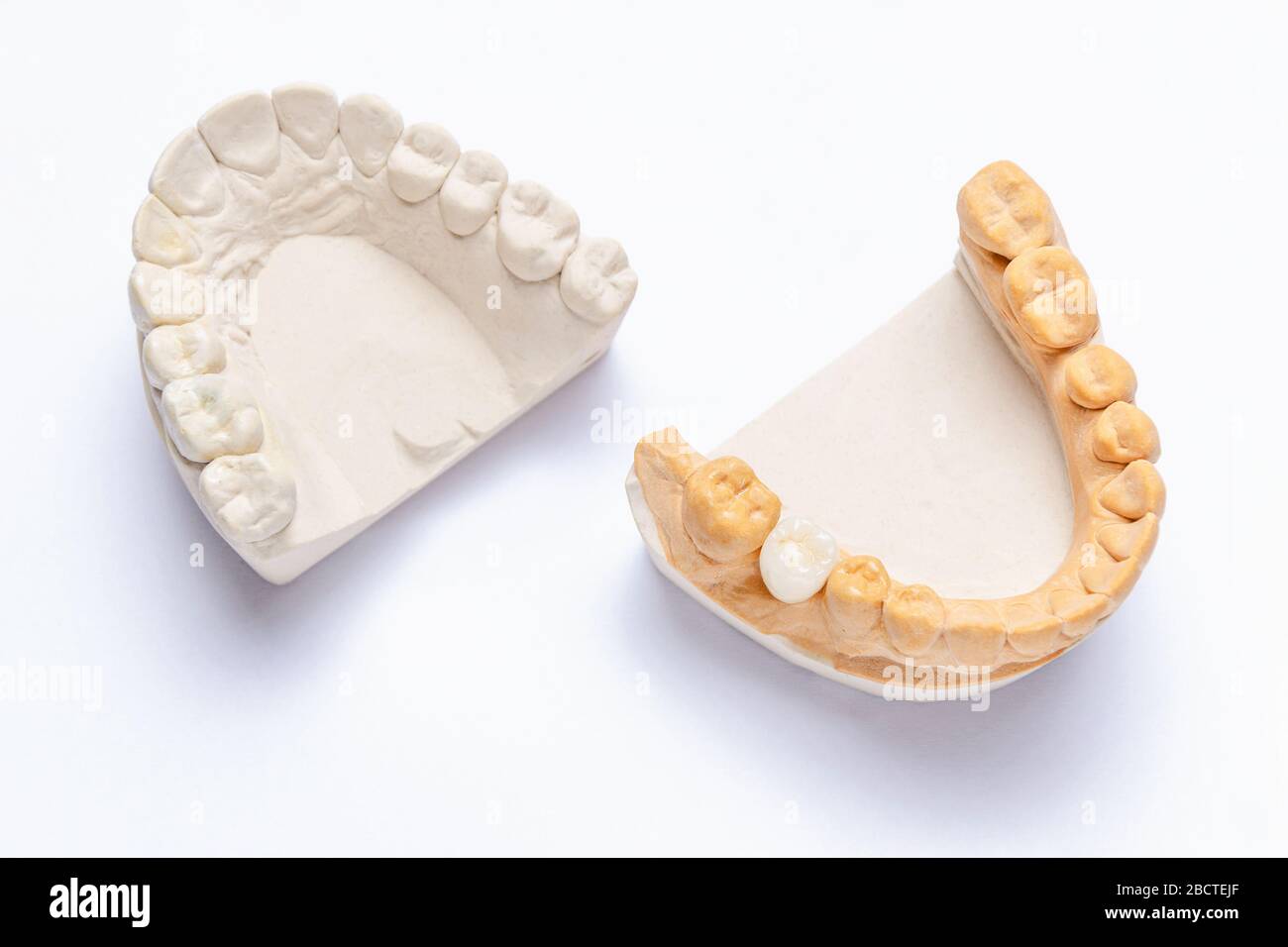 on a white background are plaster models of the jaws with a ceramic ...