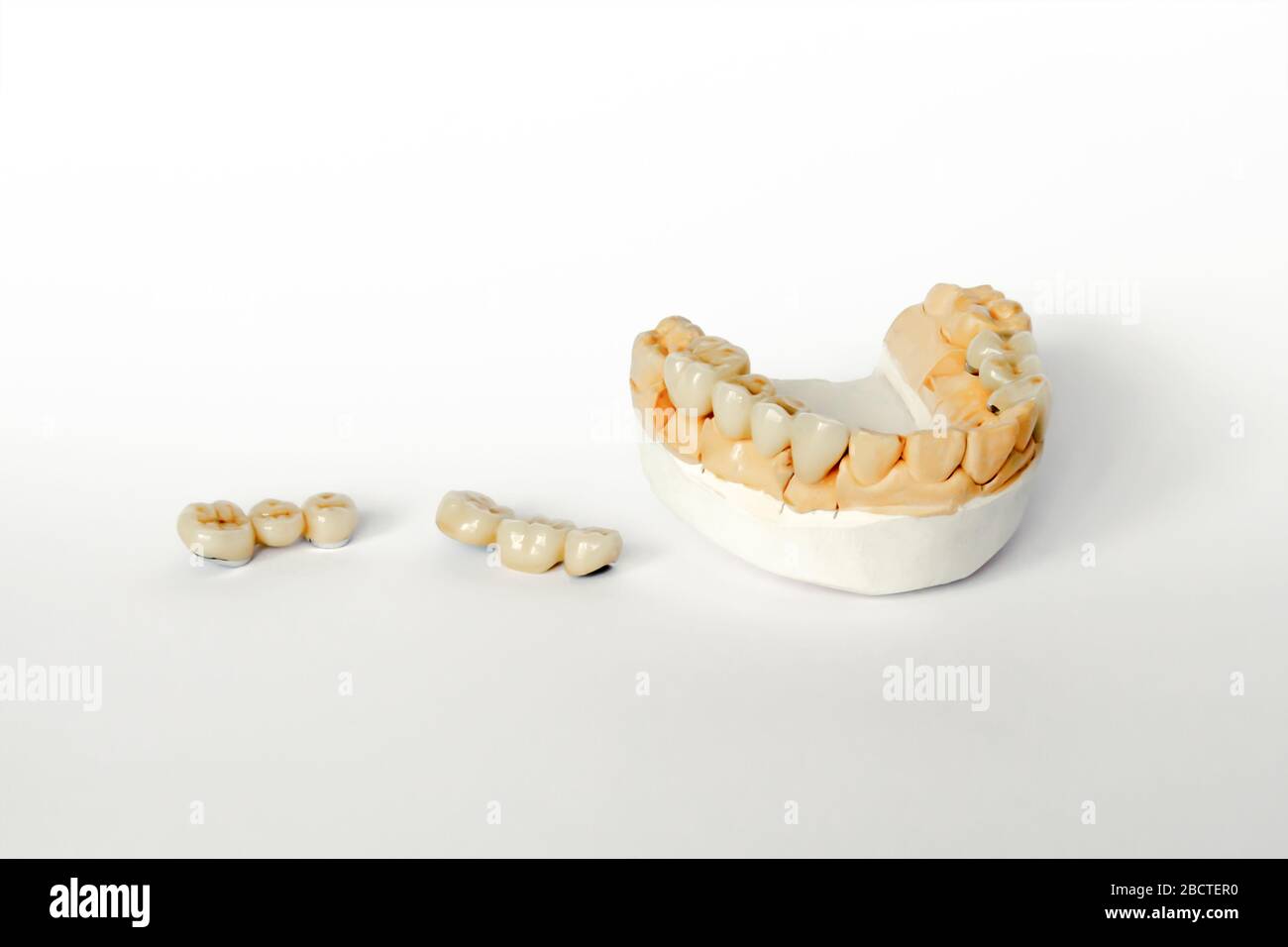 orthopedic dentistry. tooth replacement concept. dental prosthetics ...