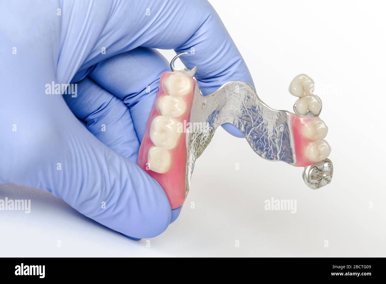 removable clasp prosthesis with clam fixation on the upper jaw in the ...