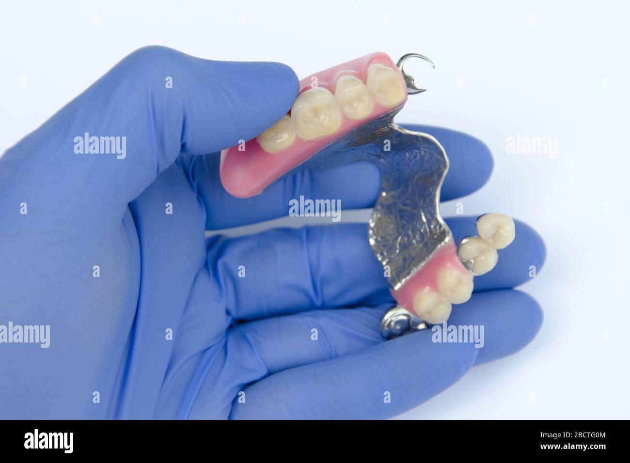 removable clasp prosthesis on the upper jaw with ceramic-metal crowns ...