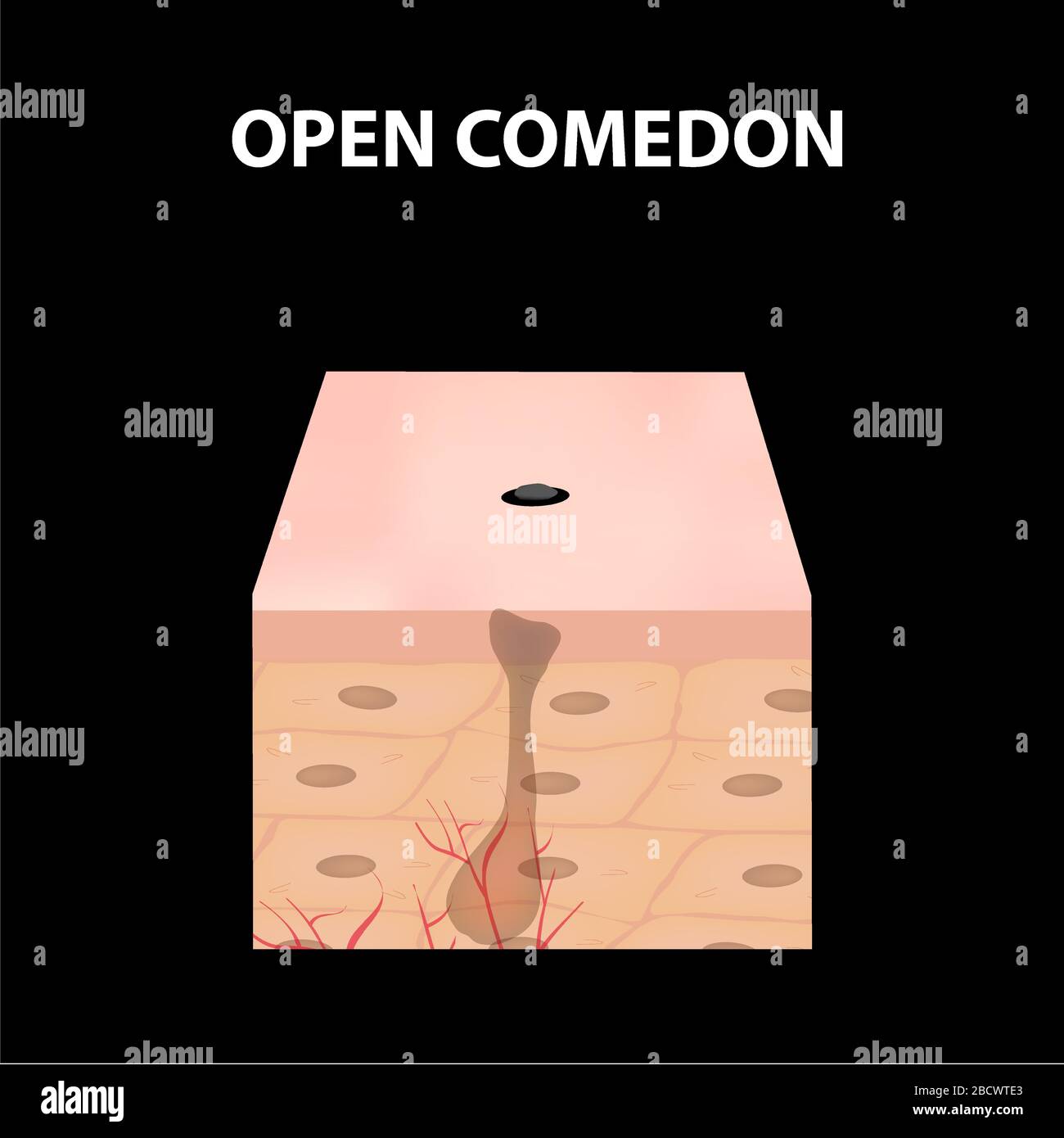 Open comedones. Acne on the skin. Dermatological and cosmetic diseases ...