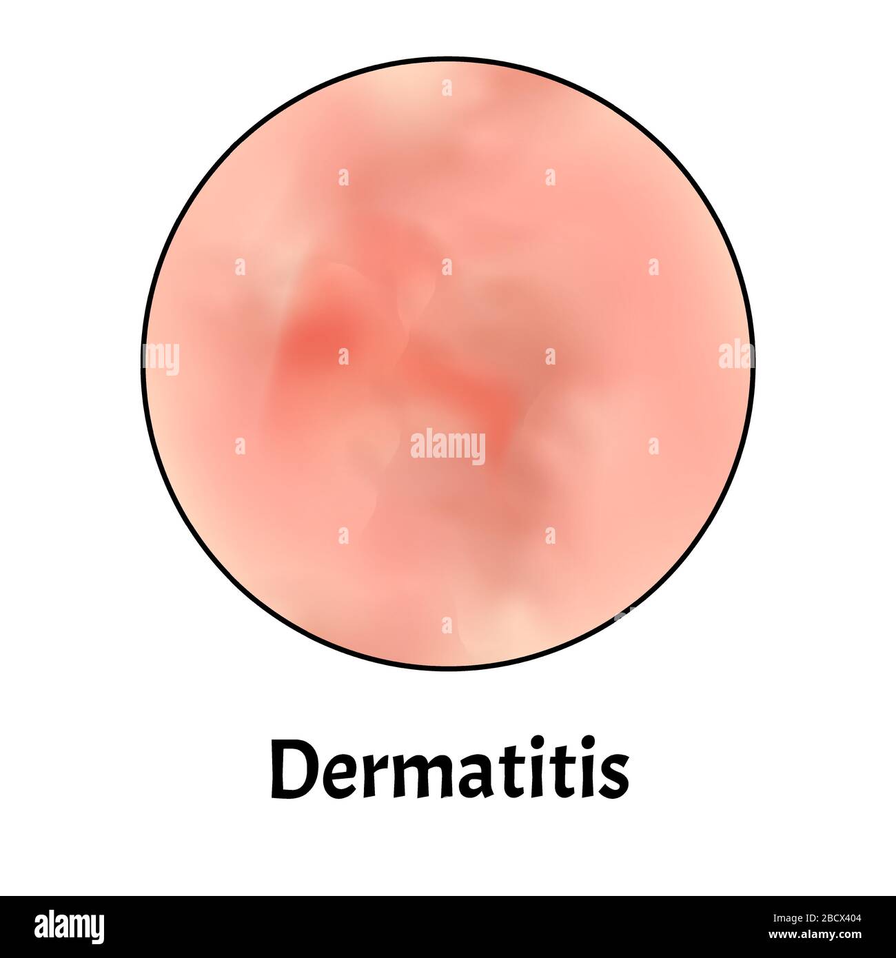 Skin inflammation. Dermatitis skin. Infographics. Vector illustration ...