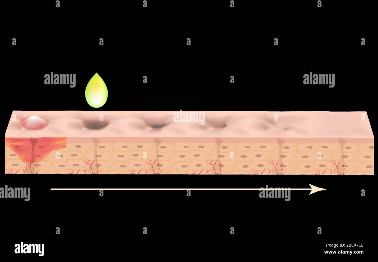Atrophic scars. Acne scar. The anatomical structure of the skin with ...