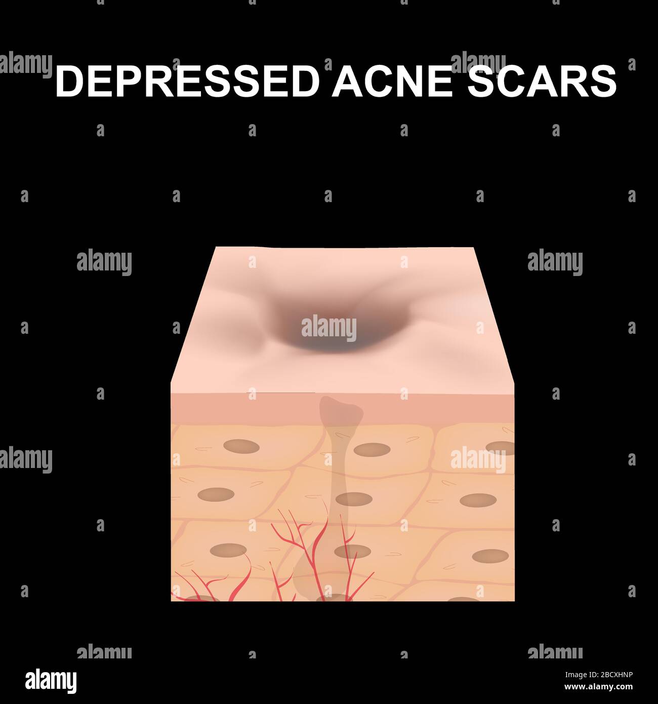 Hypertrophic Scar Stock Vector Images - Alamy