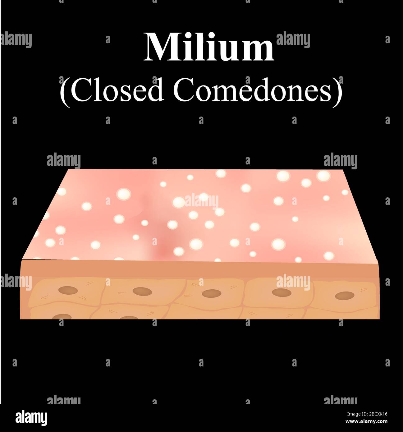 Closed comedones. Acne on the skin. Dermatological and cosmetic ...