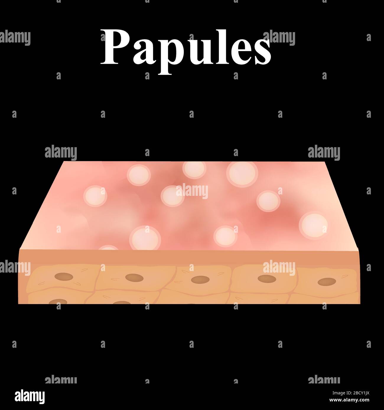 Papules. Acne on the skin. Dermatological and cosmetic diseases on the ...