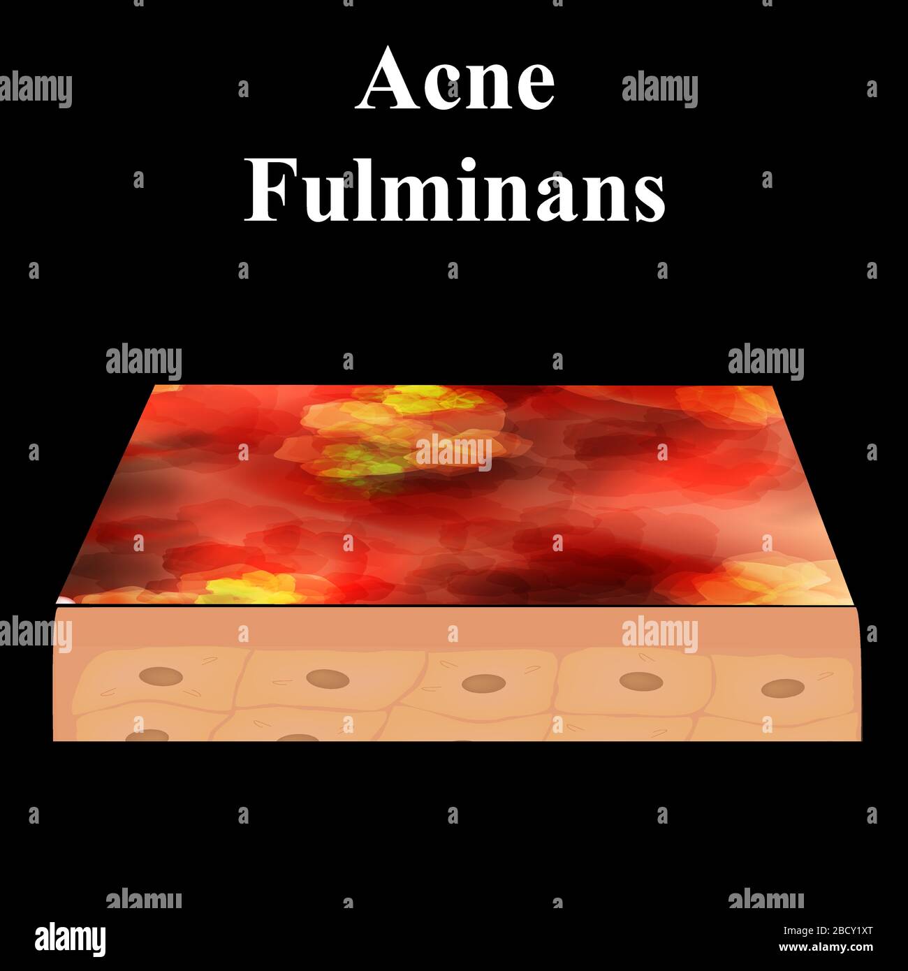 Cyst acne. furuncle Acne on the skin cysts and pimples. Dermatological ...