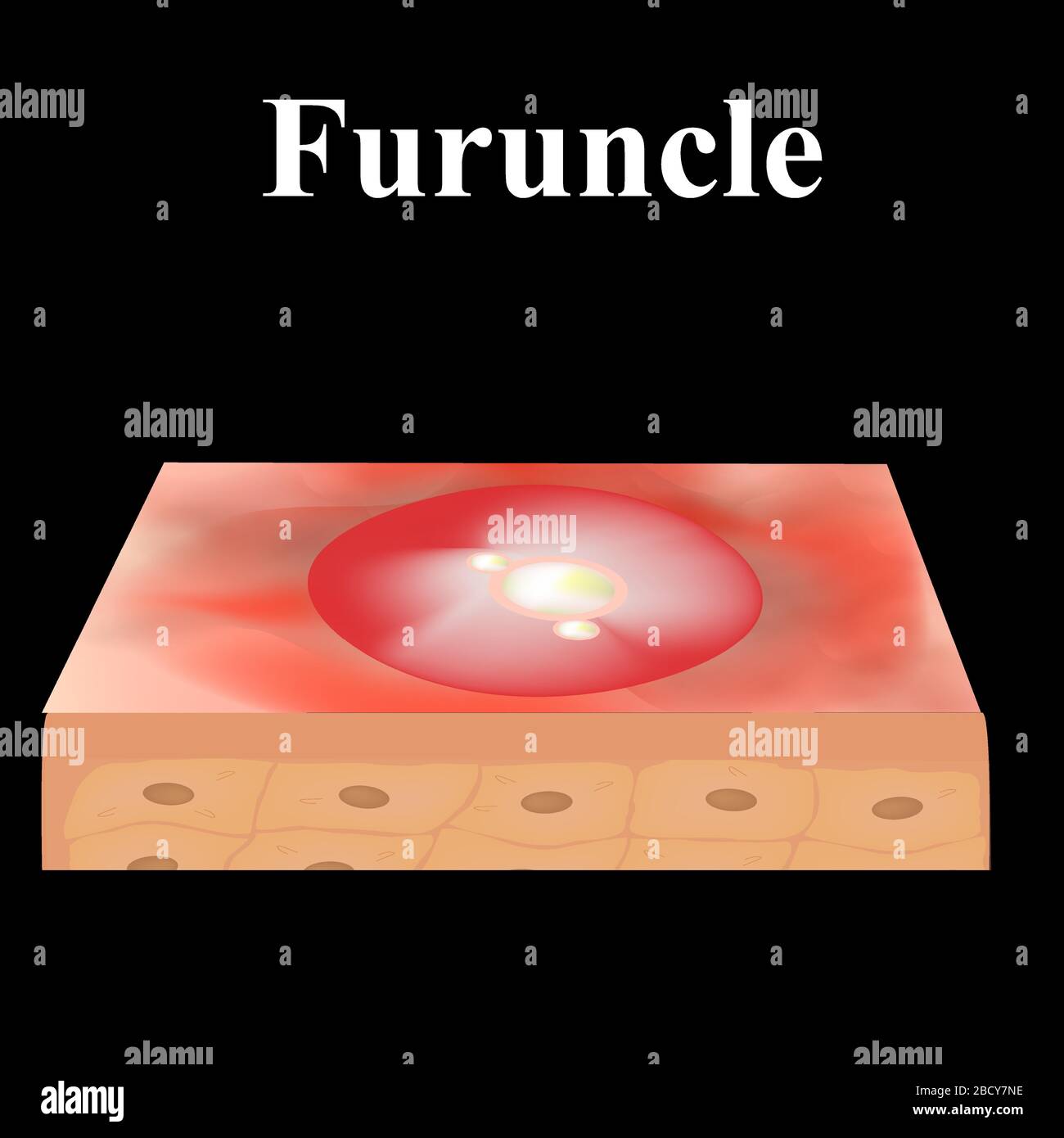 Cyst acne. furuncle Acne on the skin cysts and pimples. Dermatological ...