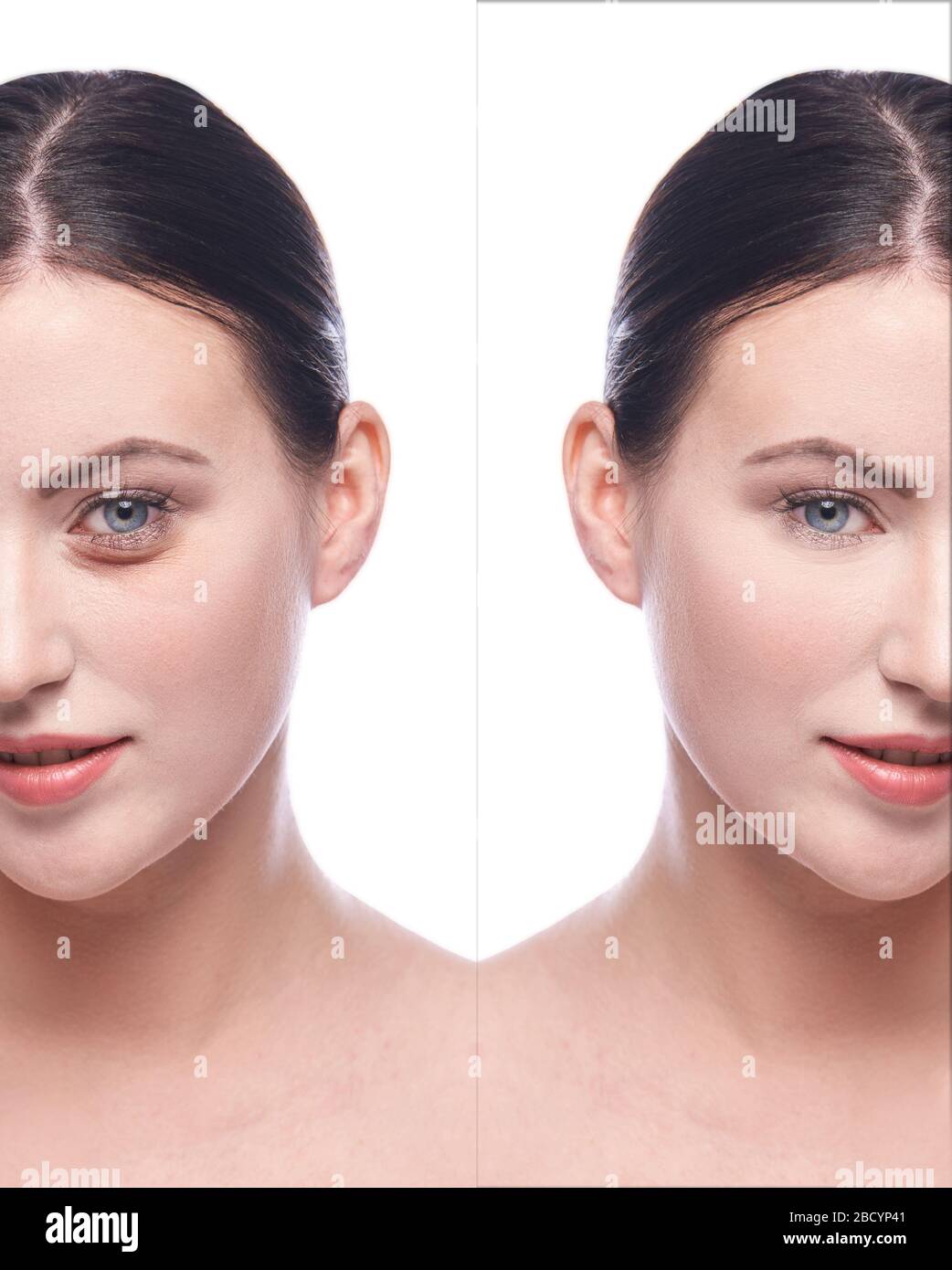 Girl before and after cosmetology plastic surgery Stock Photo - Alamy
