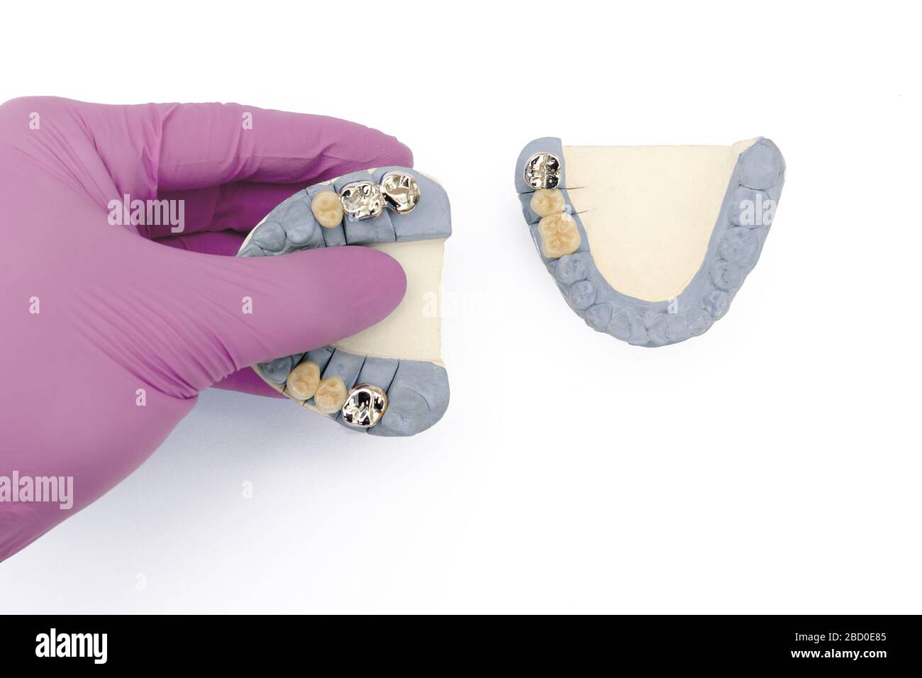 ceramic-metal crowns and bridges on the upper and lower jaws. dental ...