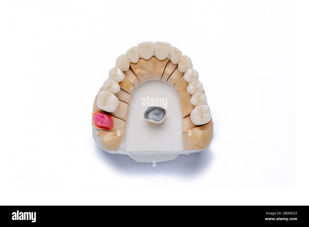 ceramic-metal bridge. concept of prosthetics with ceramic crowns and ...