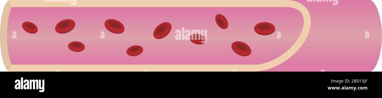 Normal and clogged artery Stock Vector Images - Alamy