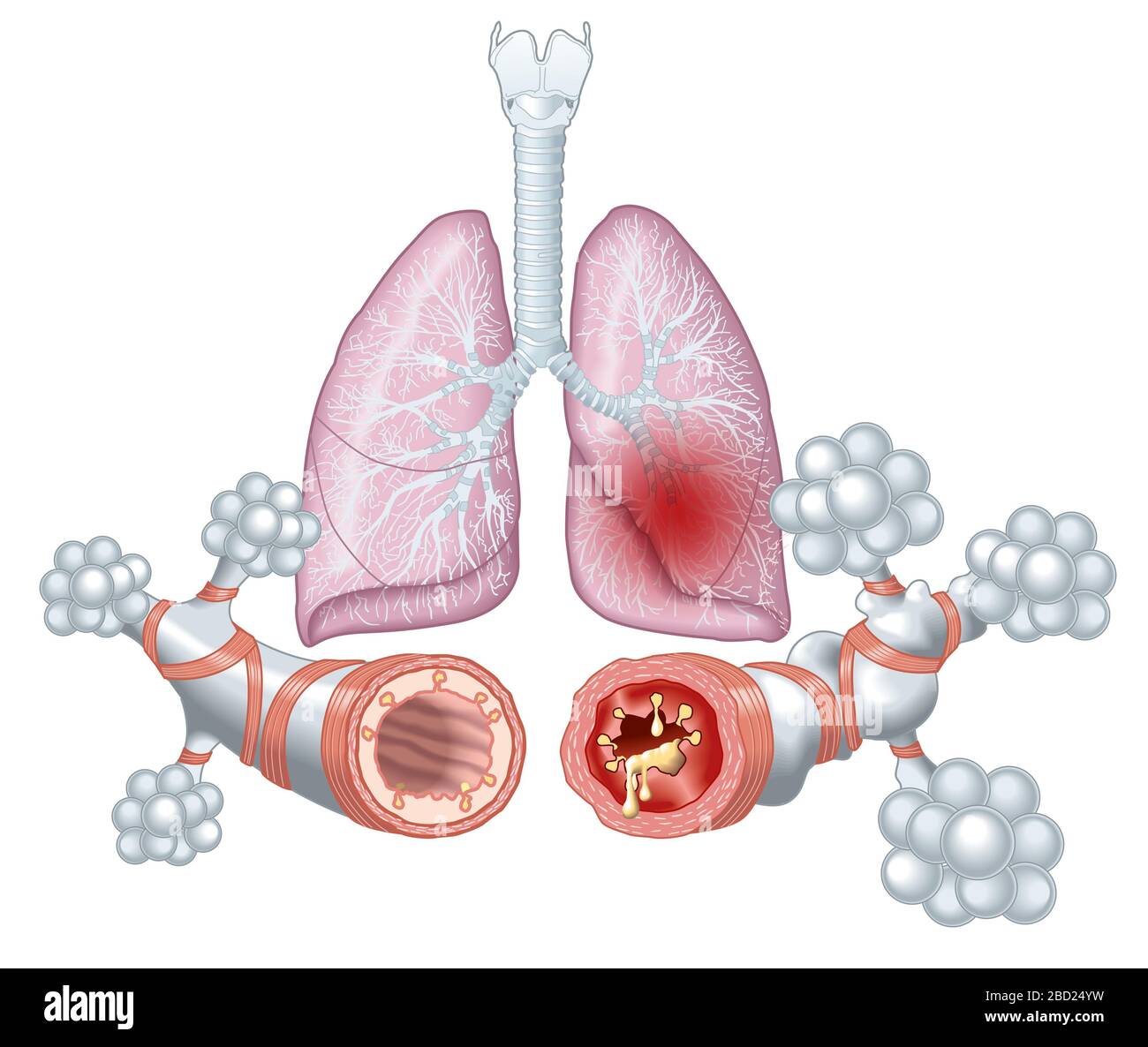 Diagram showing Asthma, normal and asthmatic airways, medically ...