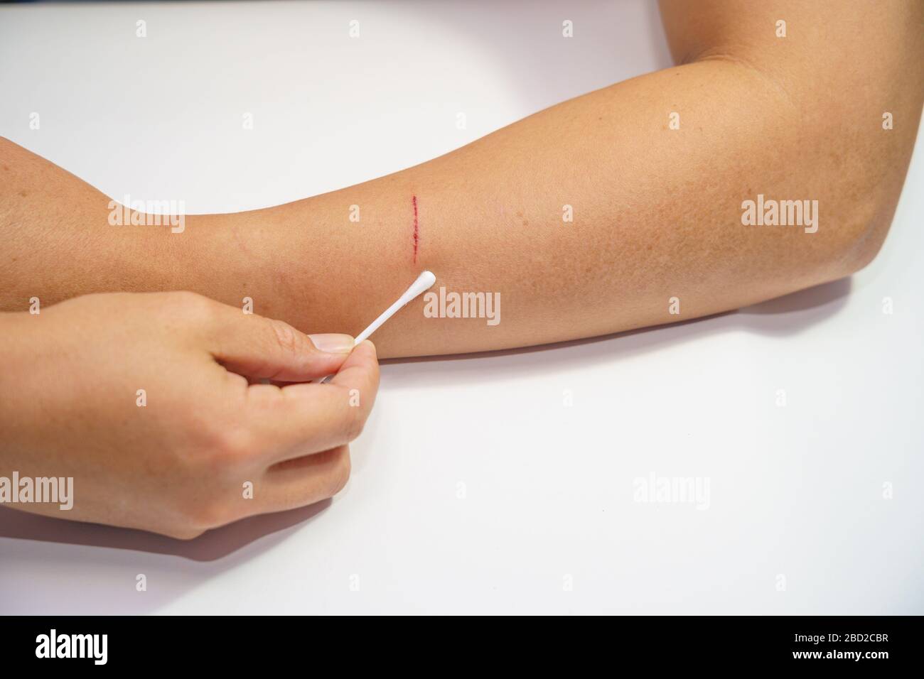 Laceration Wound High Resolution Stock Photography and Images - Alamy