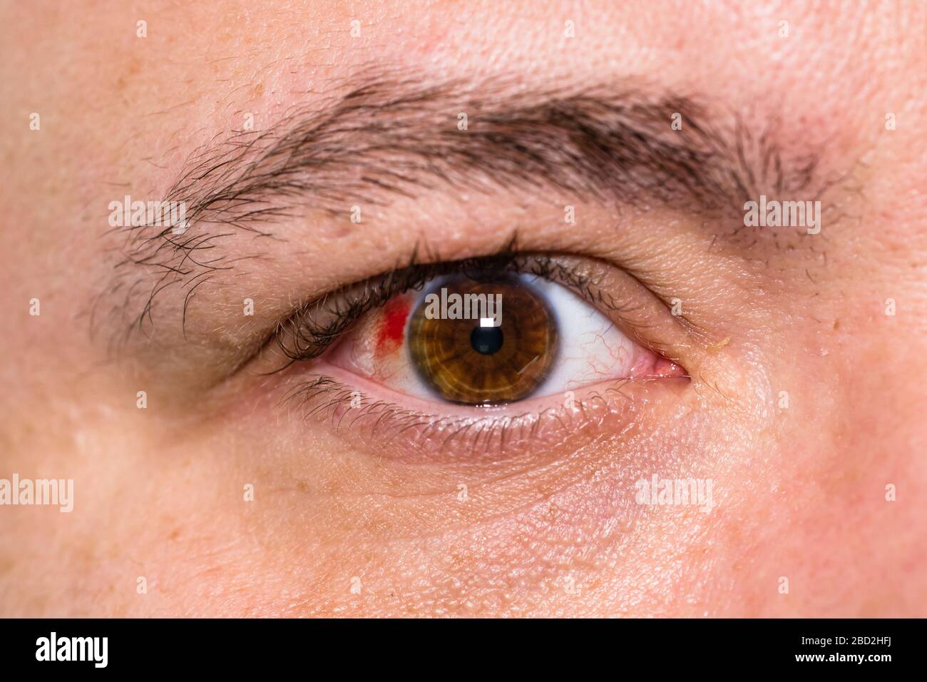 Eye injury, young man with burst blood vessel in eye, fatigue, problems ...