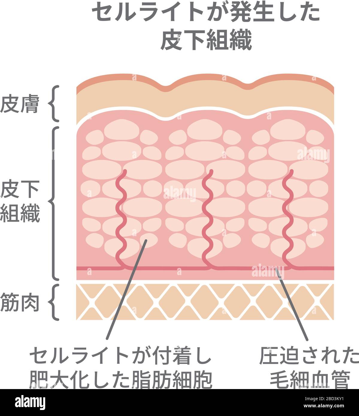 Cellulite's skin sectional view illustration Stock Vector Image & Art ...