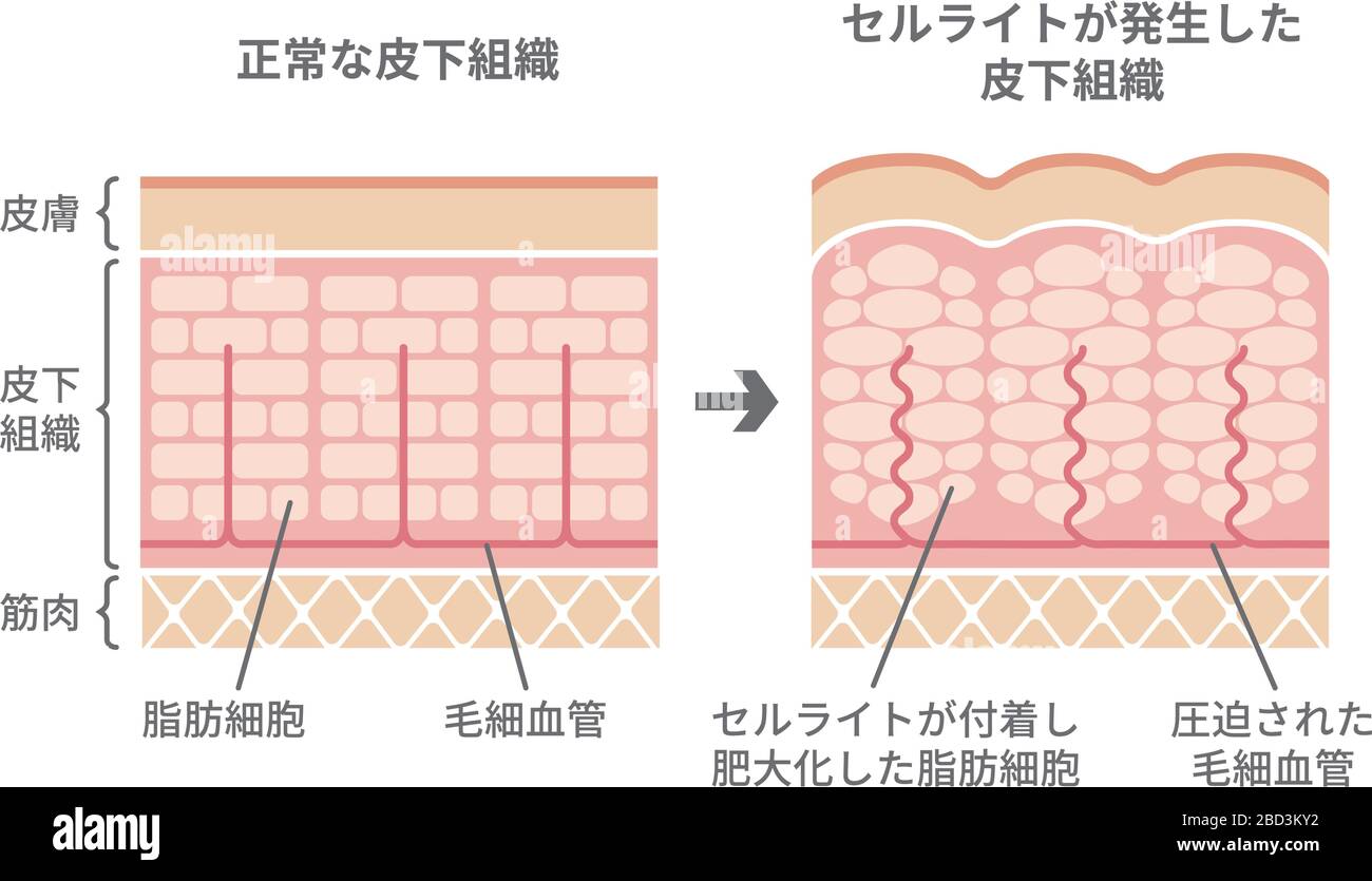 Comparative illustration of normal skin and cellulite's skin Stock ...