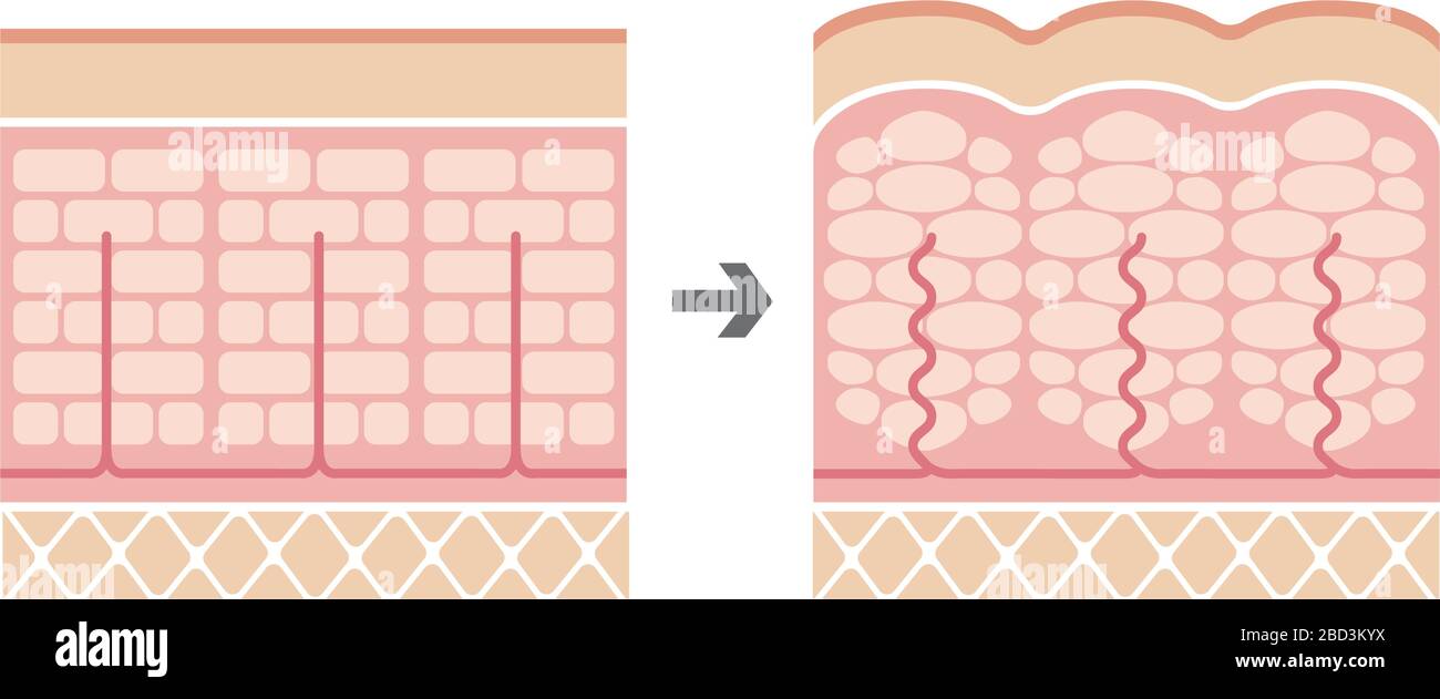 Comparative illustration of normal skin and cellulite's skin Stock ...