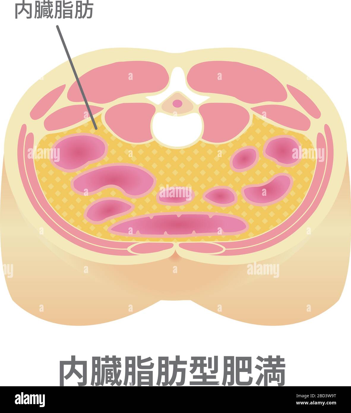 Type of obesity illustration . Abdominal sectional View (visceral fat ...