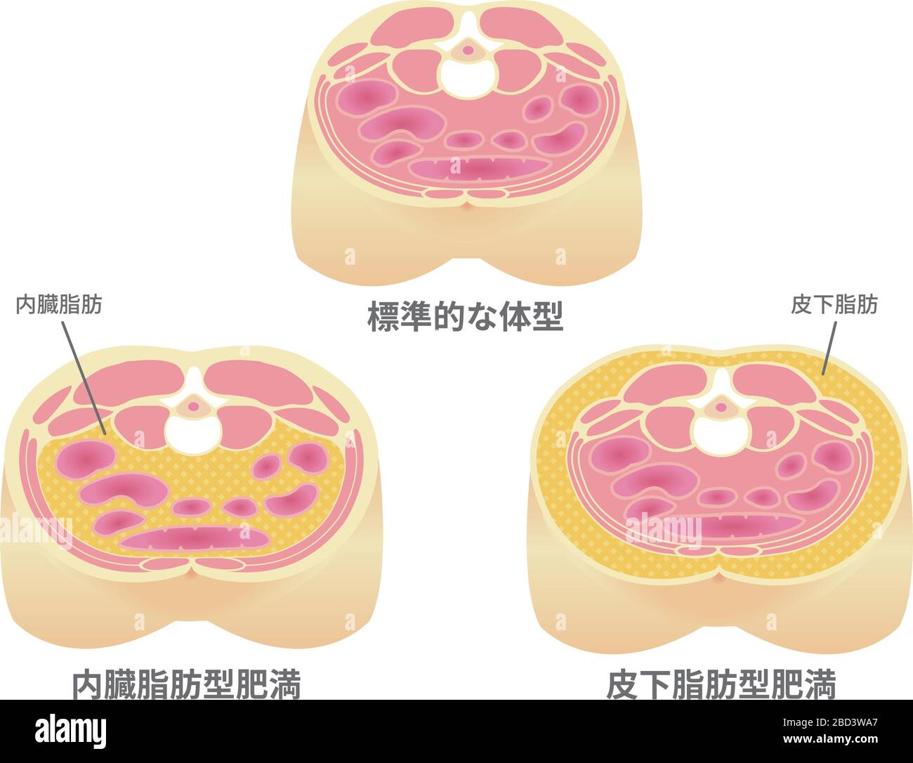 Type of obesity illustration. Abdominal sectional View. (visceral fat ...
