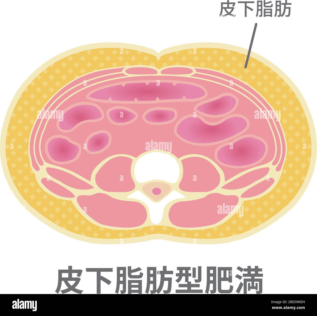 Type of obesity illustration . Abdominal sectional View (subcutaneous ...