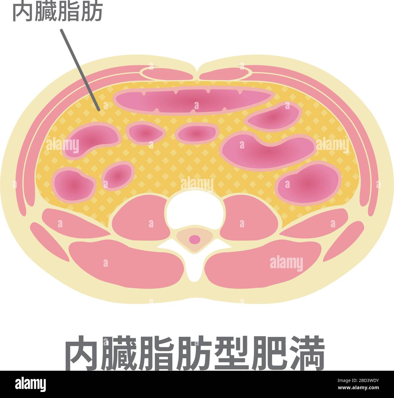 Type of obesity illustration . Abdominal sectional View (visceral fat ...