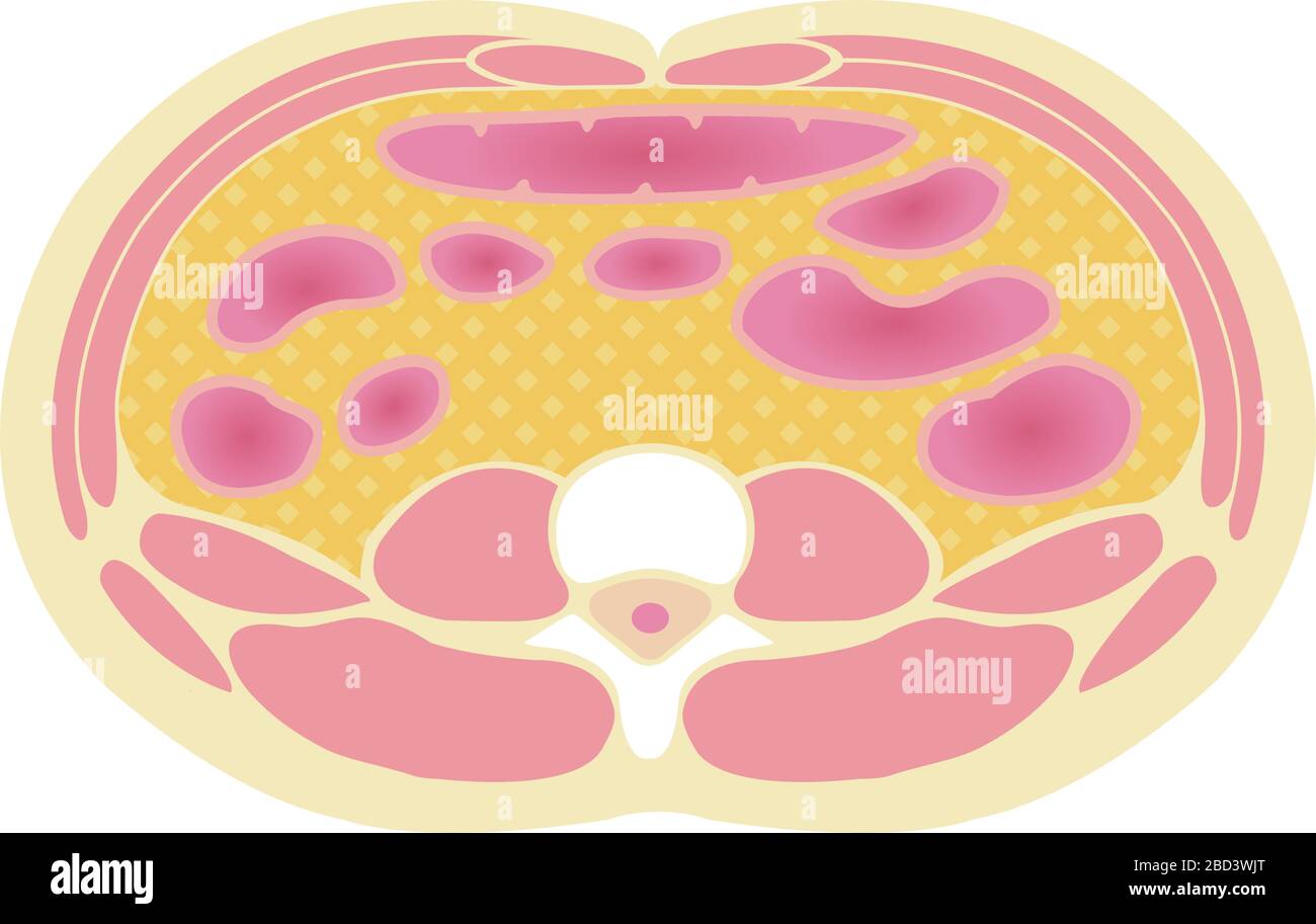Type of obesity illustration . Abdominal sectional View (visceral fat ...