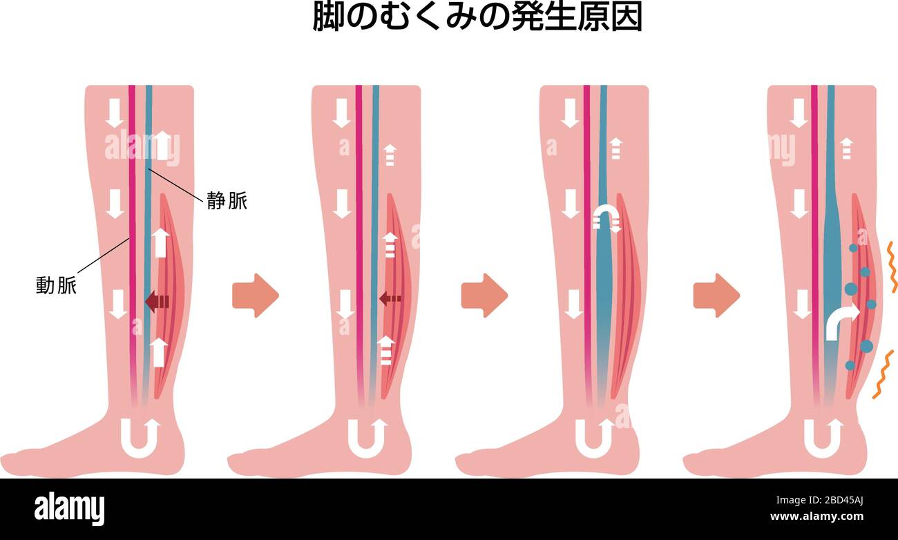 Deep vein thrombosis illustration hi-res stock photography and images ...