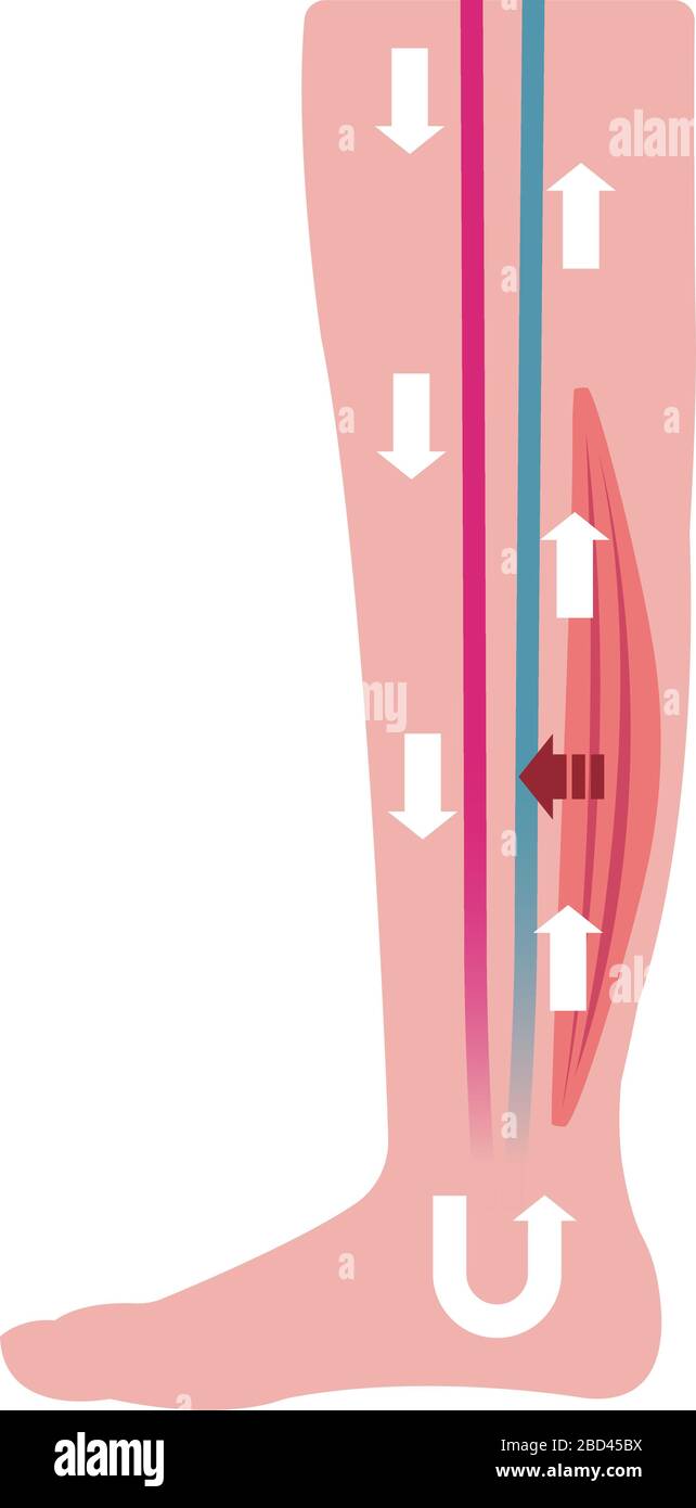 Cause of swelling(edema) of the legs. flat illustration of normal leg ...