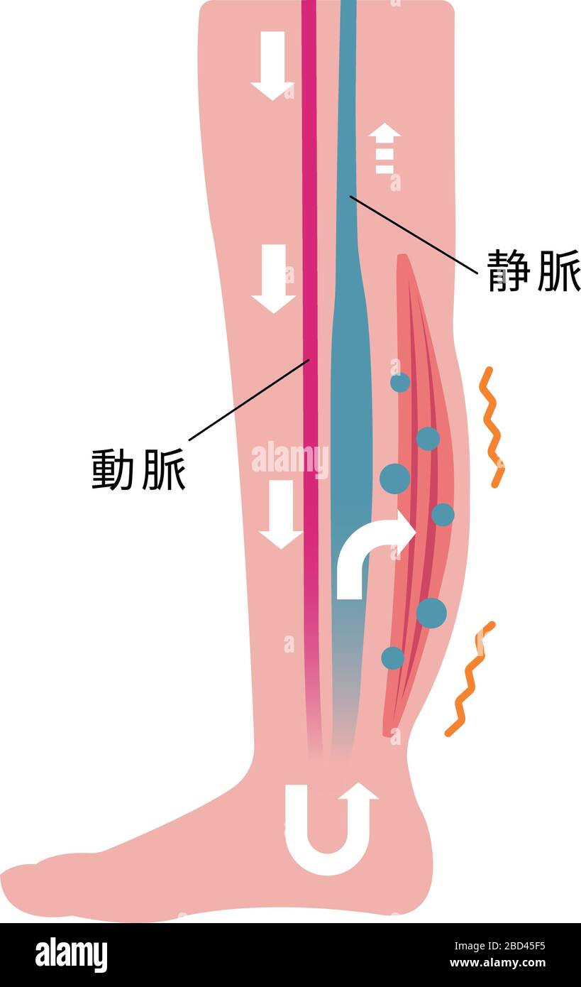 Cause of swelling(edema) of the legs. Water leaks from the veins and ...
