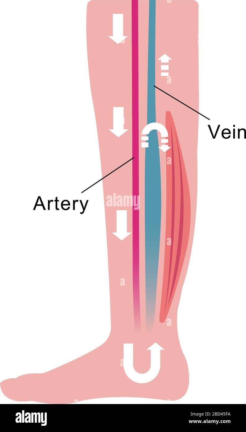Cause of swelling(edema) of the legs. Water in the blood stagnates and ...