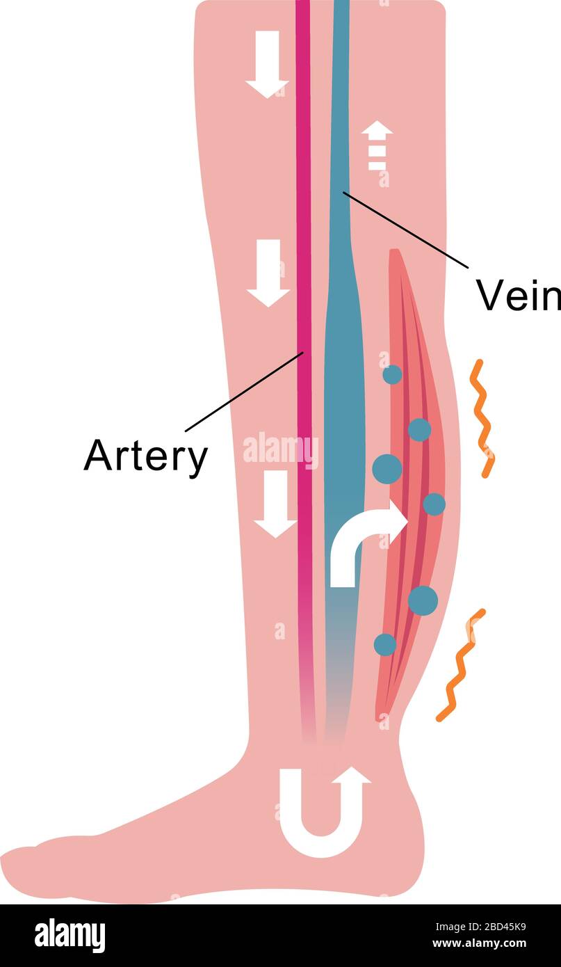 Cause of swelling(edema) of the legs. Water leaks from the veins and ...