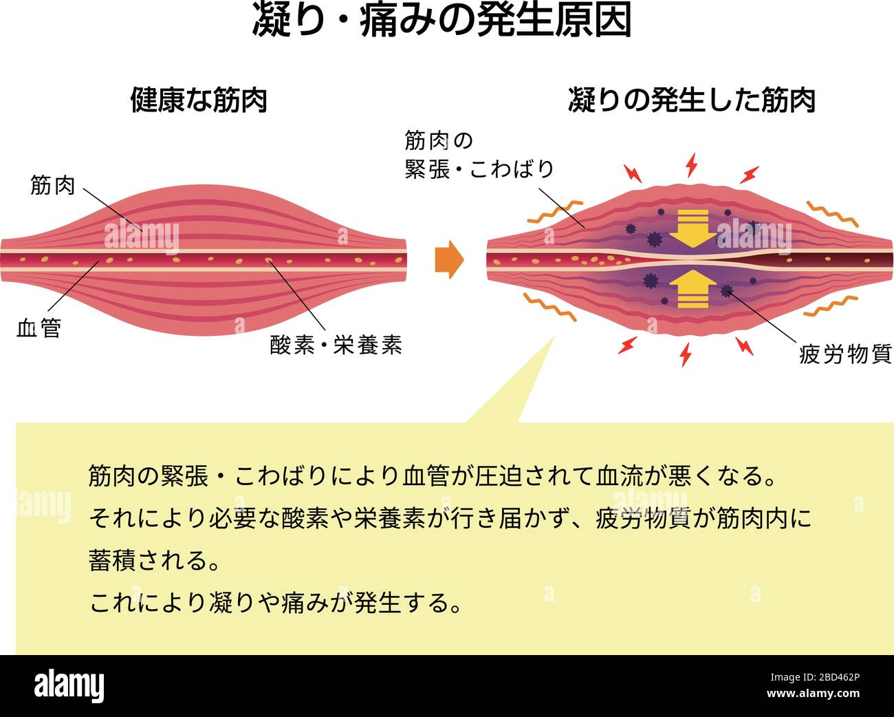 Cause of muscle's stiffness and pain illustration Stock Vector Image ...