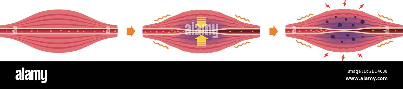 Cause of muscle's stiffness and pain illustration (3 steps Stock Vector ...