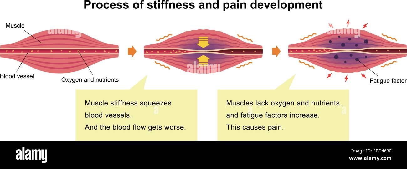 Cause of muscle's stiffness and pain illustration (3 steps Stock Vector ...