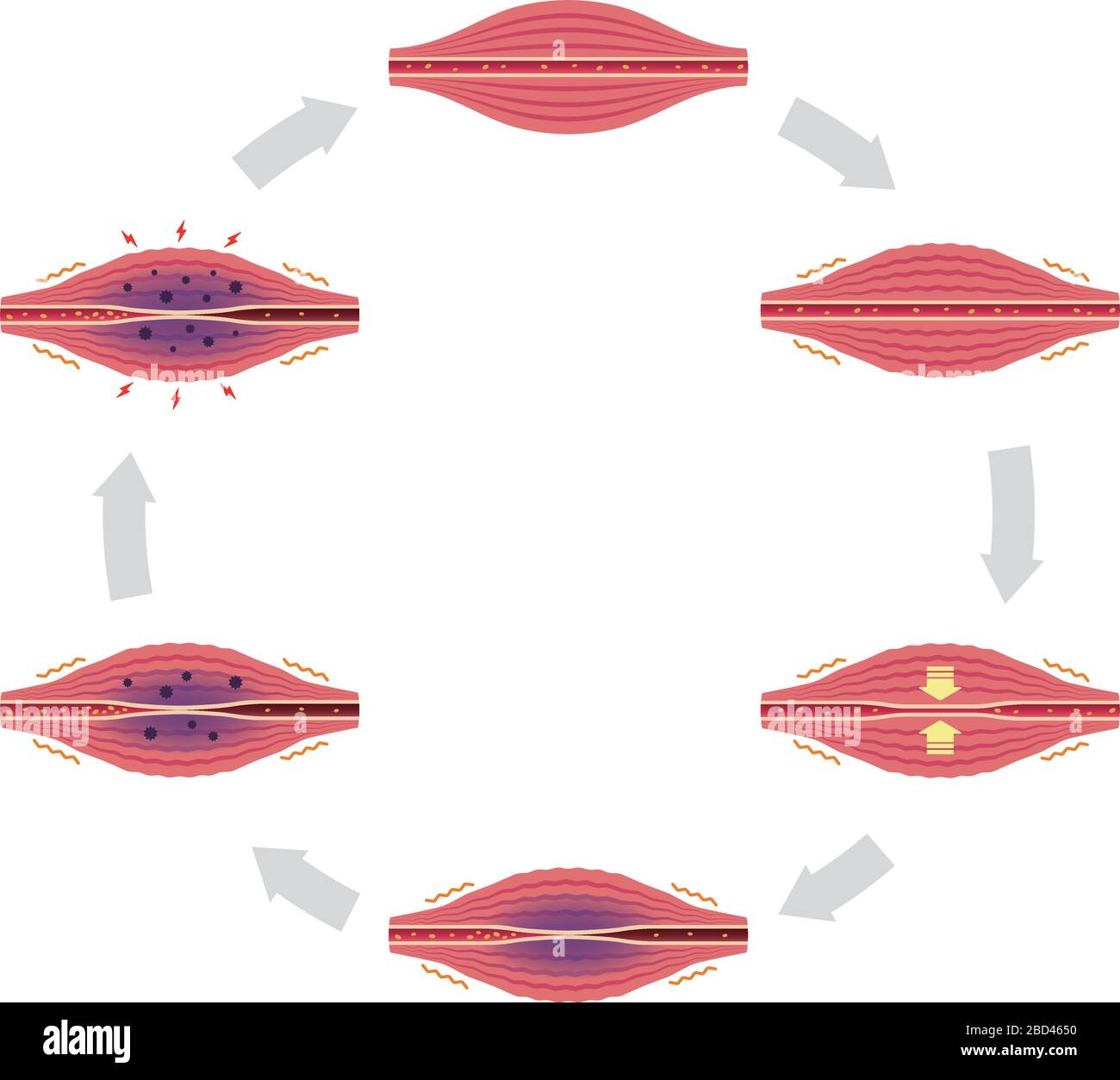 Process of muscle's stiffness and pain / circle type illustration Stock ...