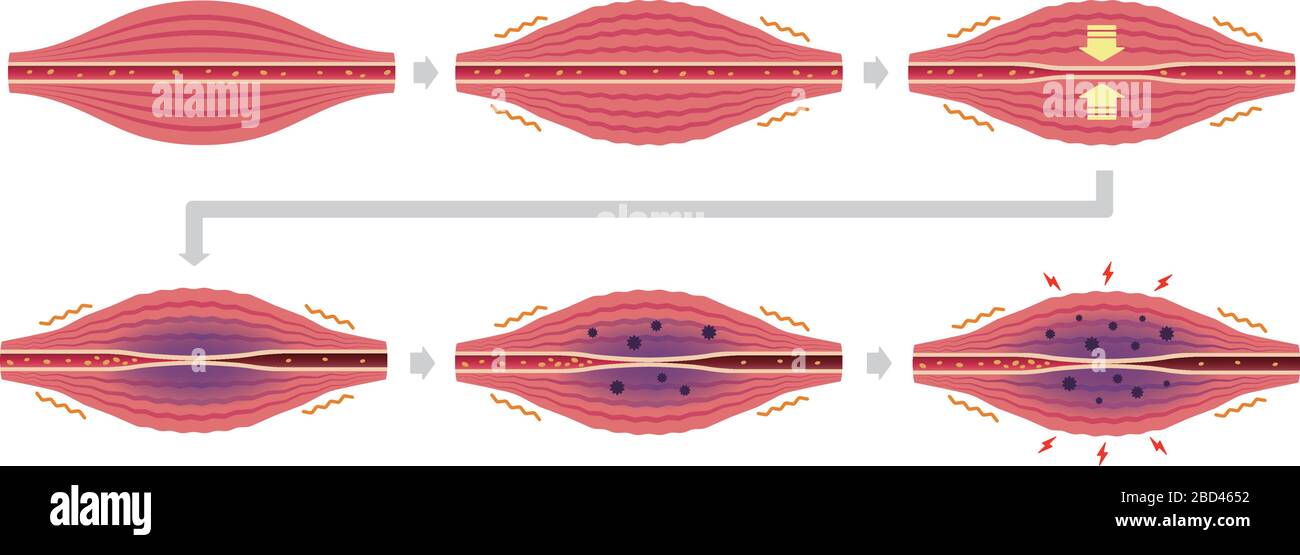 Process of muscle's stiffness and pain illustration ( 6 steps Stock ...
