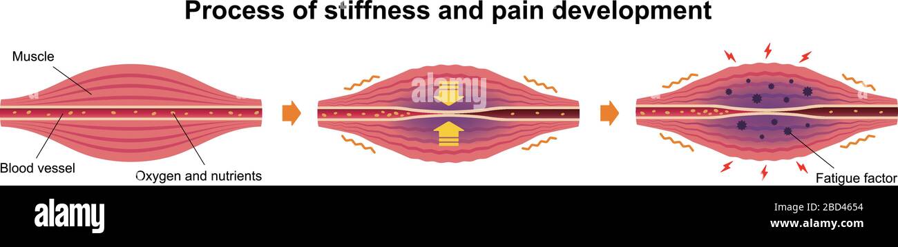 Cause of muscle's stiffness and pain illustration (3 steps Stock Vector ...