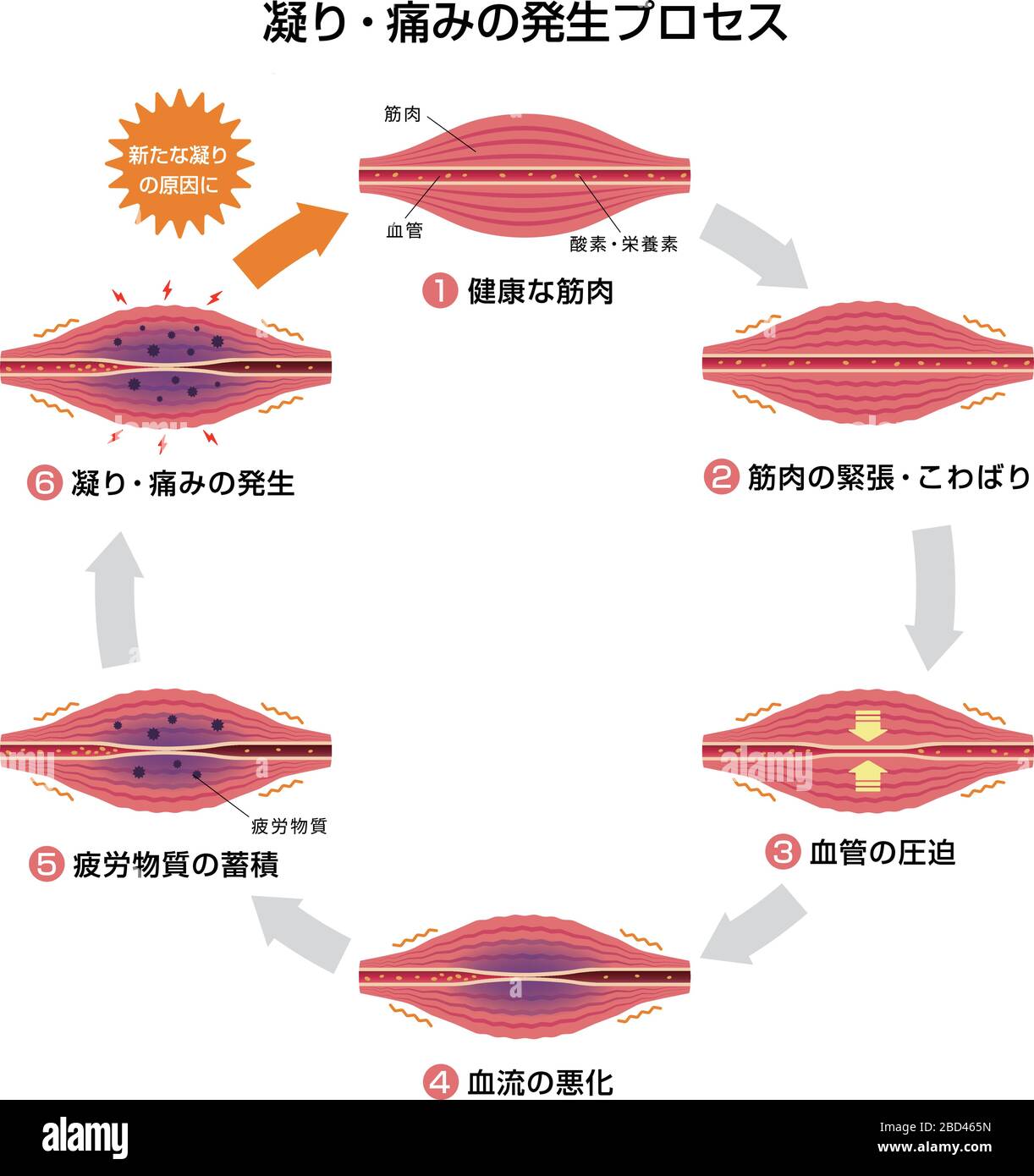 Process of muscle's stiffness and pain / circle type illustration Stock ...