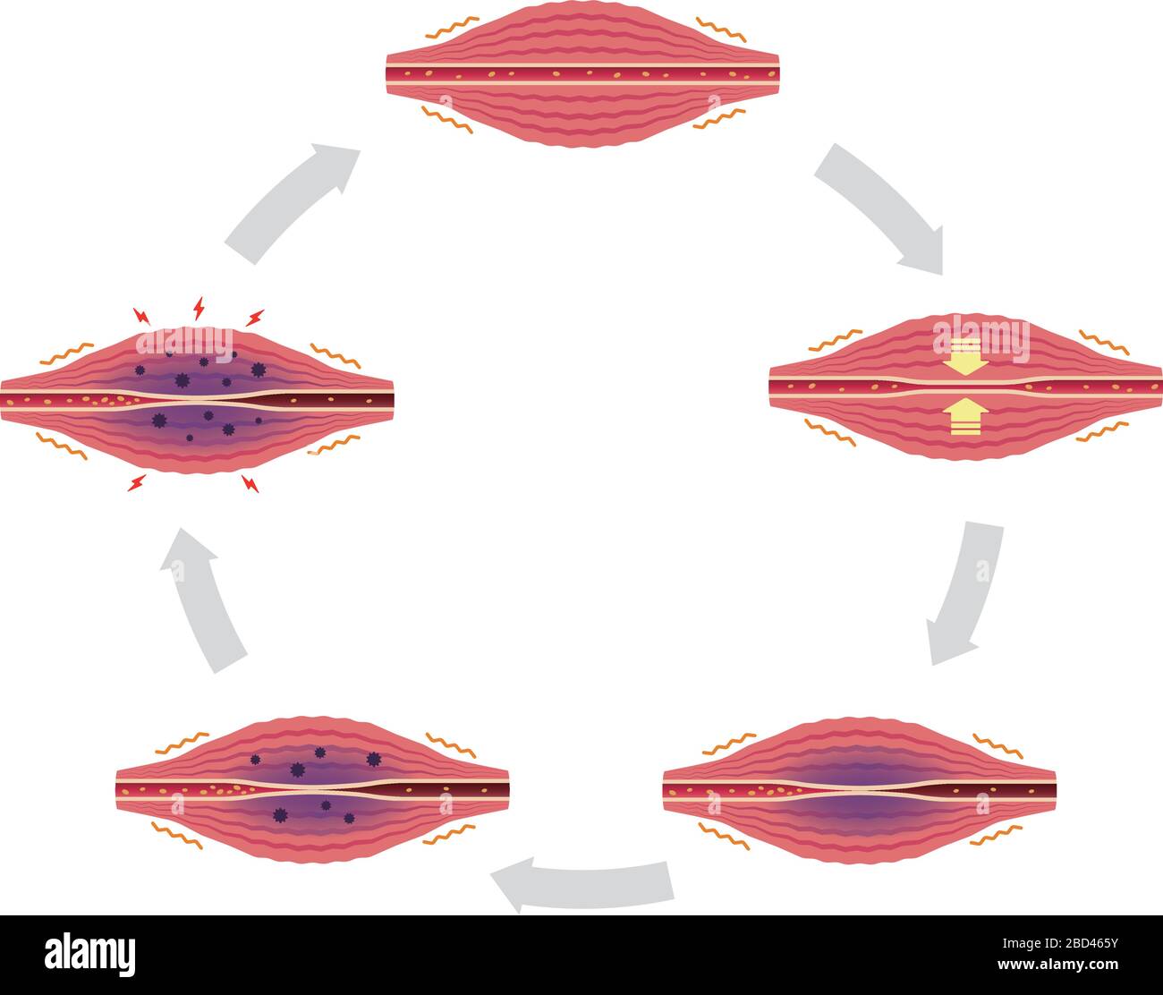 Cycle of stiffness and pain , and spiral of chronicification ...