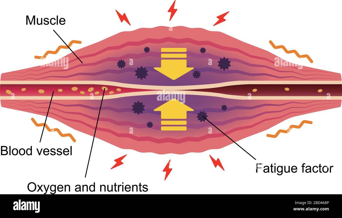 Muscle Cramp Diagram