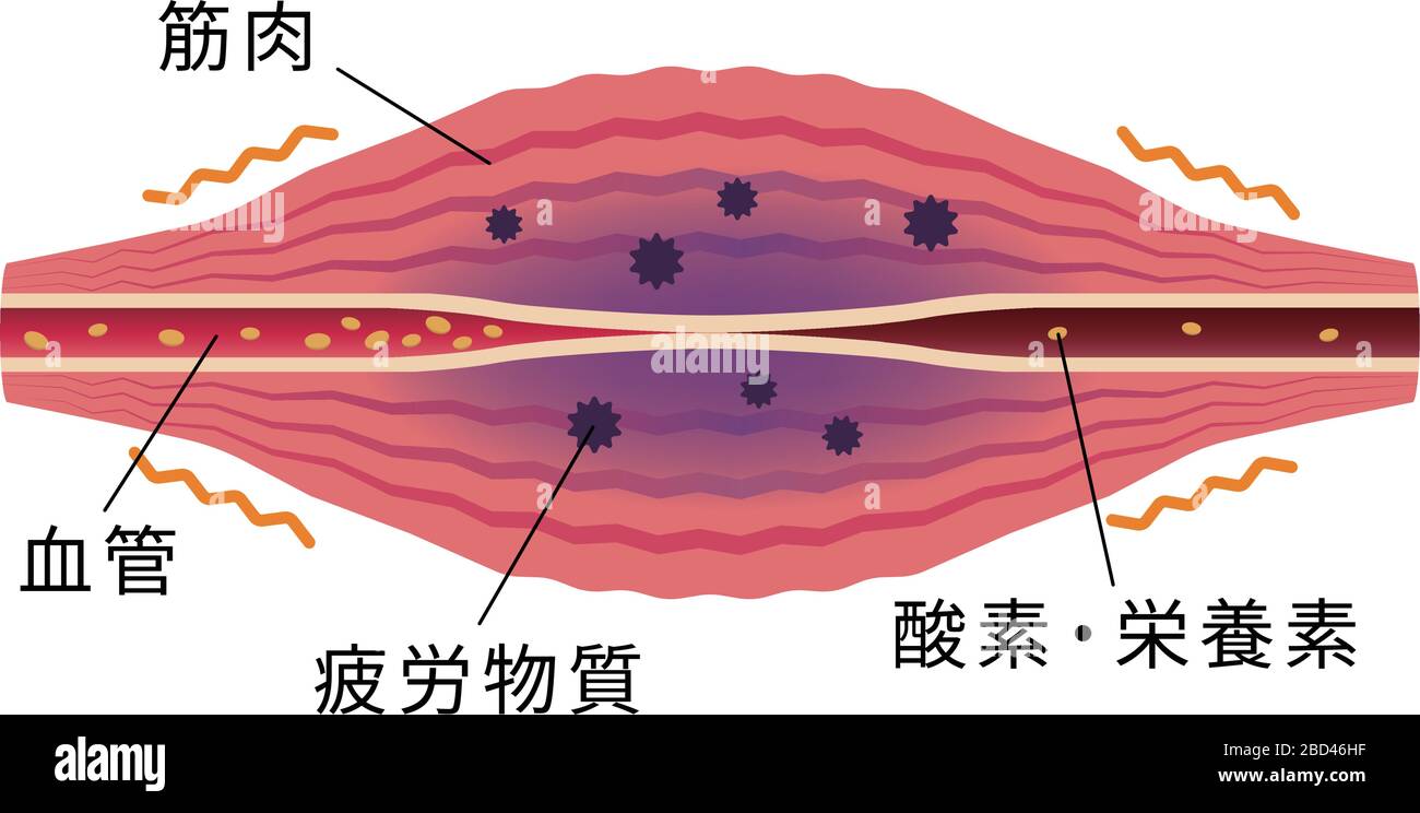Fatigue factors accumulate . Flat illustration of muscle and vessel ...