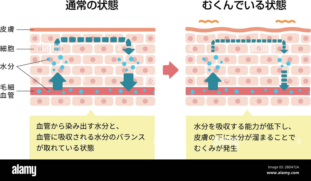 Comparison illustration of normal skin and swollen skin Stock Vector ...