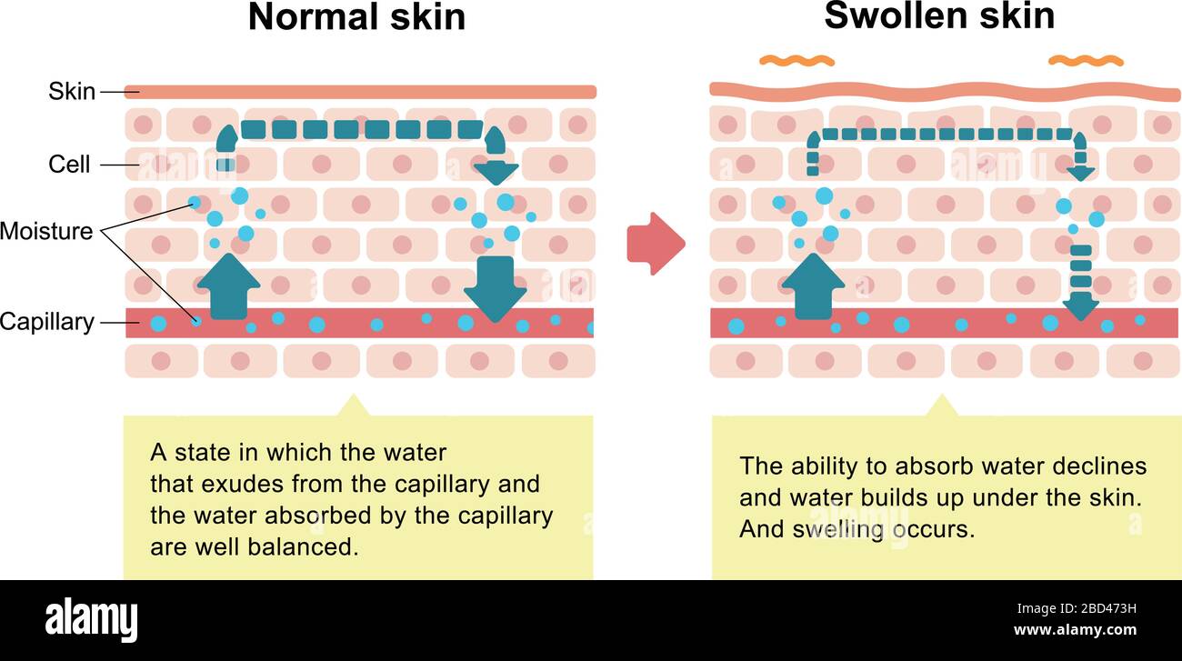 Swollen skin Cut Out Stock Images & Pictures - Alamy