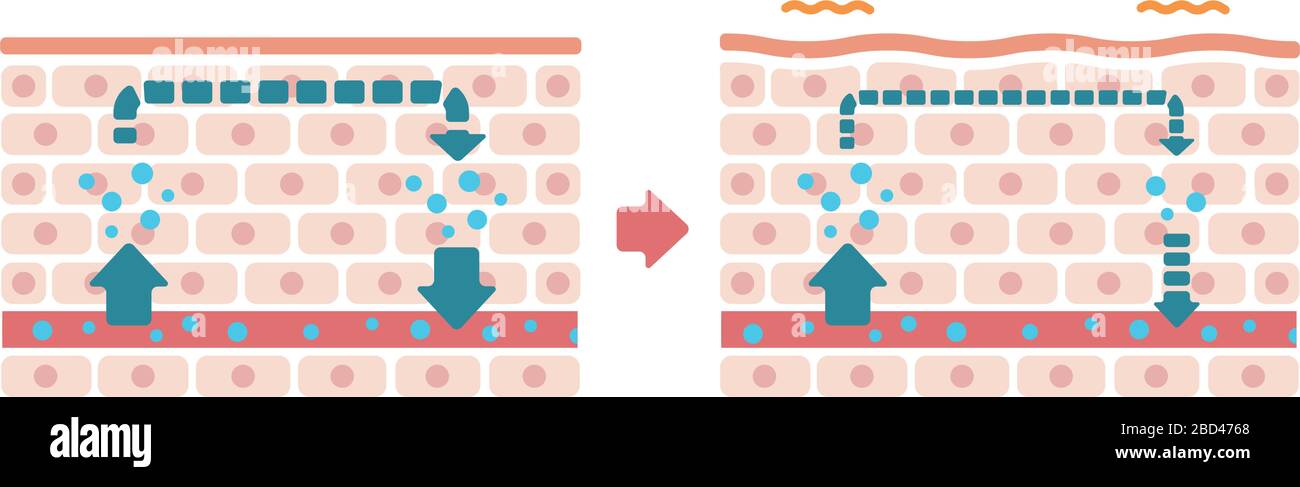 Comparison illustration of normal skin and swollen skin Stock Vector ...