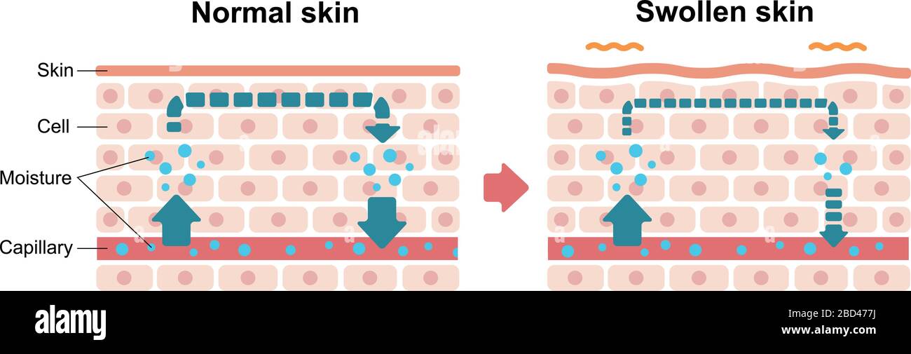 Swollen skin hi-res stock photography and images - Alamy