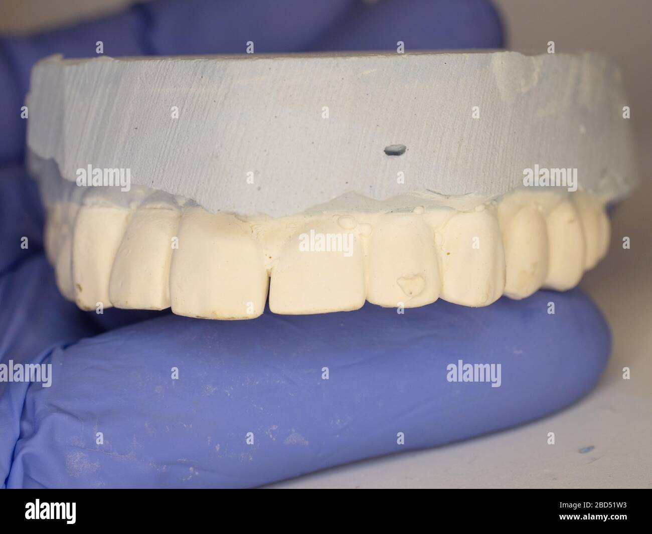 Denture gypsum teeth model. Upper palate of dentist laboratory patient ...