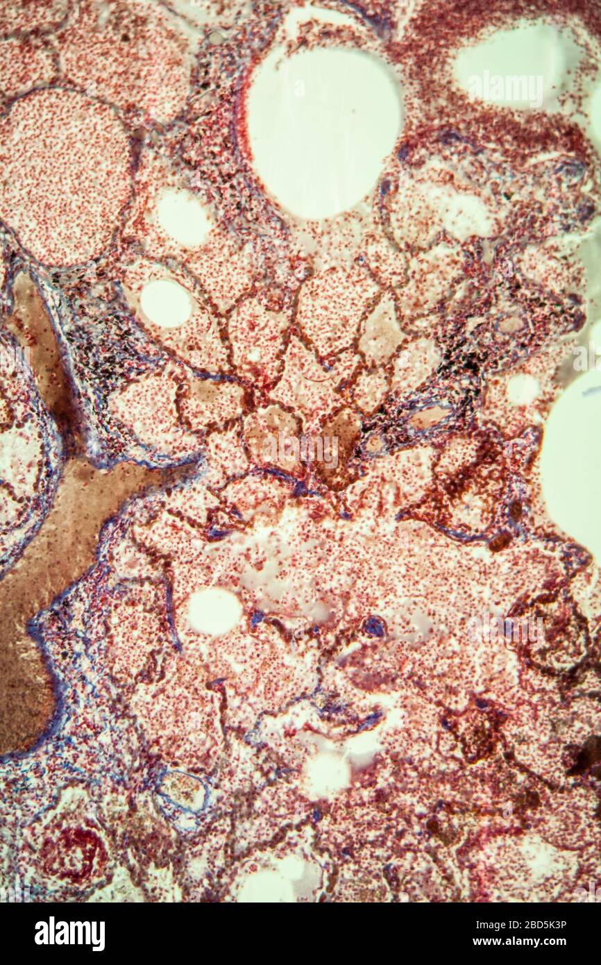 Tuberculosis tissue under the microscope 100x Stock Photo - Alamy
