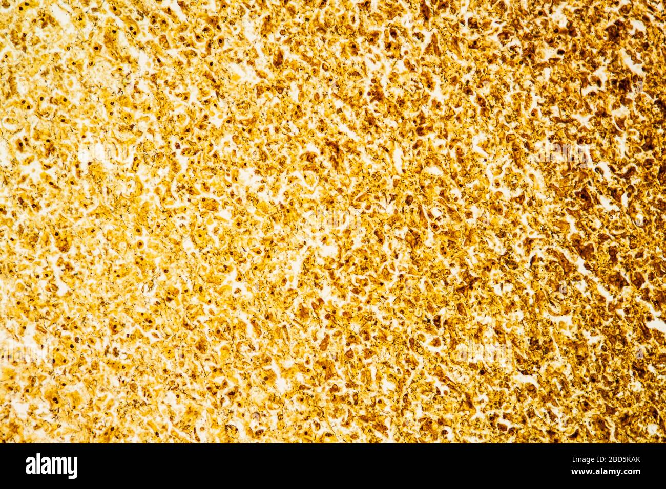 Lues, syphillis of the liver tissue 200x Stock Photo - Alamy