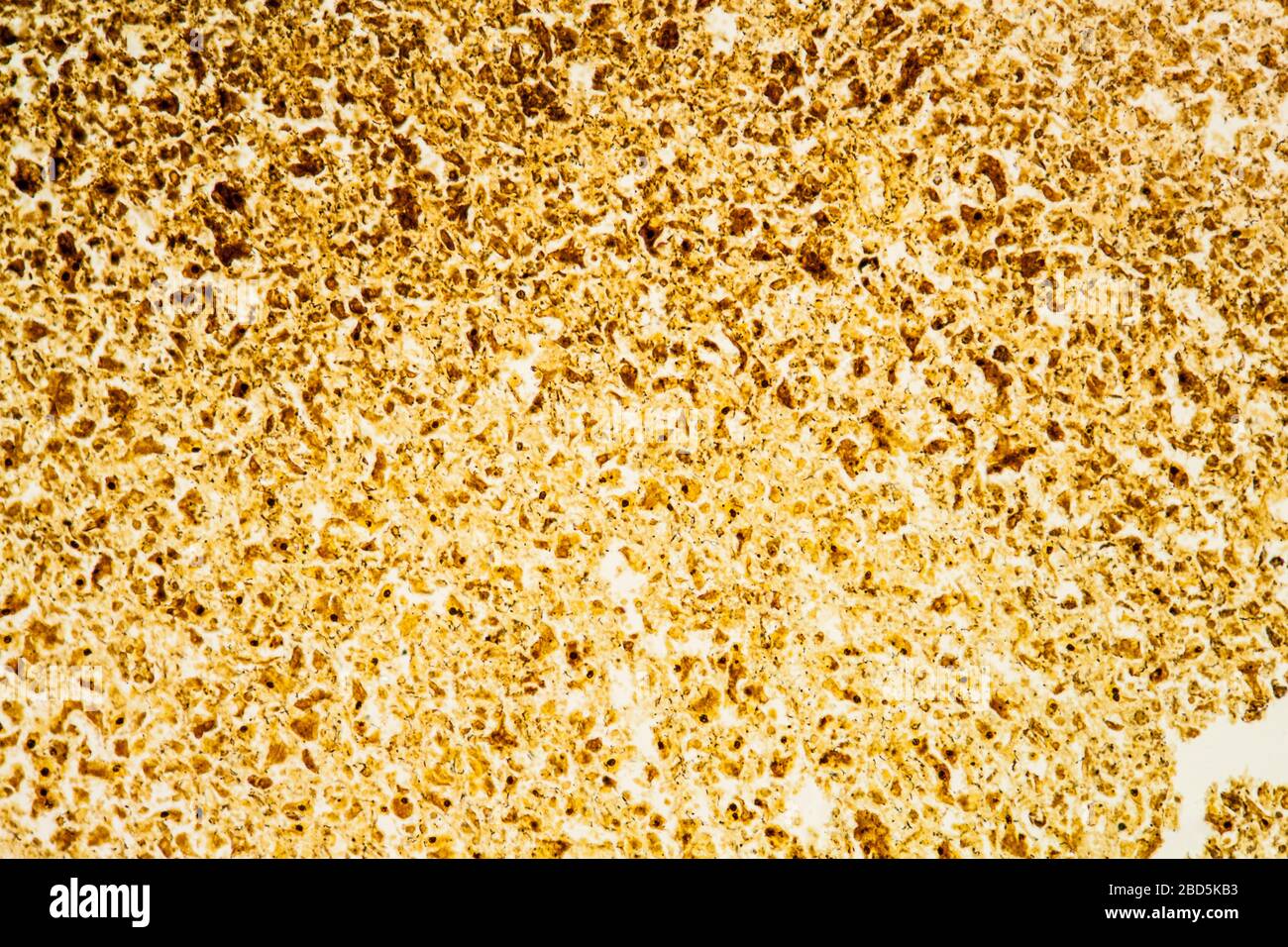 Syphilis of the liver hi-res stock photography and images - Alamy